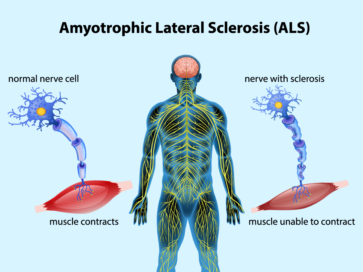 Amyotrophic lateral sclerosis (ALS) Amyotrophic lateral sclerosis (ALS)